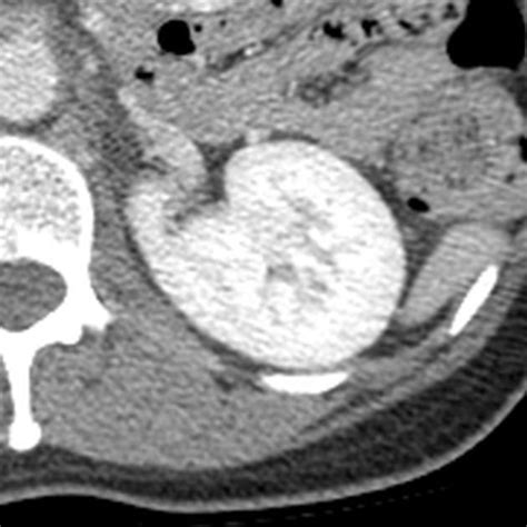 Duplicated Collecting System Pacs
