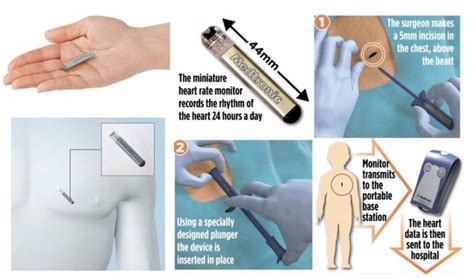 Heart Holter Monitoring To Diagnose Palpitations Get Help