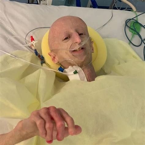 Sammy Basso Dona Il Suo Corpo Alla Scienza Grazie A Lui La Cura Per La Progeria è Più Vicina