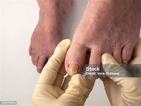 발톱 곰팡이 한 전문의가 곰팡이 감염에 걸린 발톱을 검사한다 손톱의 손톱 용해증 응급 의학 의료 페디큐어 노화 문제 건강관리와 의술에 대한 스톡 사진 및 기타 이미지