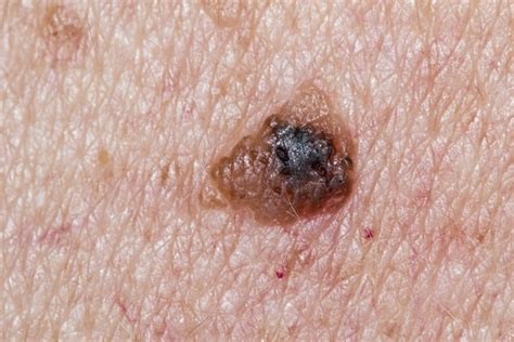 Dysplastic Nevus