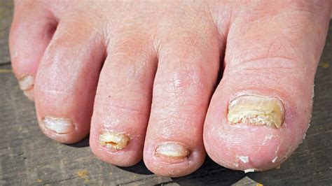 Nail Fungus Causes Symptoms Treatments And Prevention