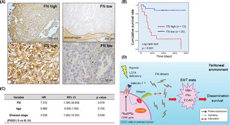 Tumor Cell Fibronectin Fn Is Correlated With The Poor Prognosis Of