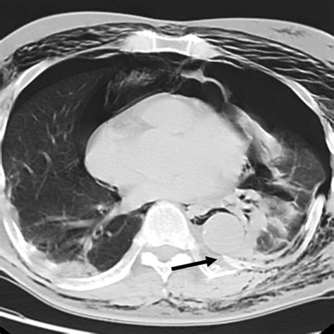 Thoracic Computed Tomography Ct On Arrival In Case 1 Ct Shows The Download Scientific