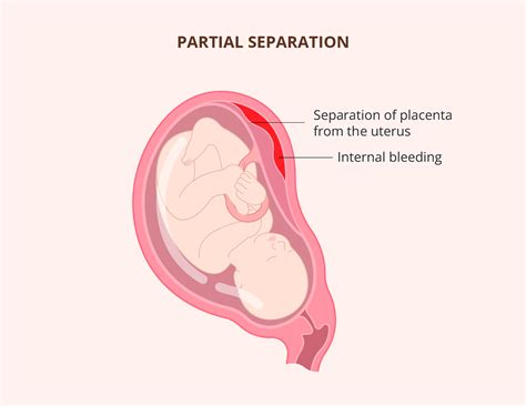 Complete Placental Abruption Placental Abruption Abruptio Placentae