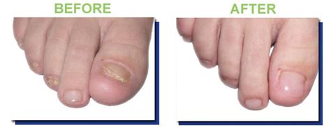No More Ugly Toenails Clark Podiatry Center