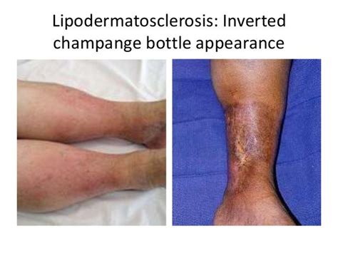 Lipodermatosclerosis Champange Appearance Bottle
