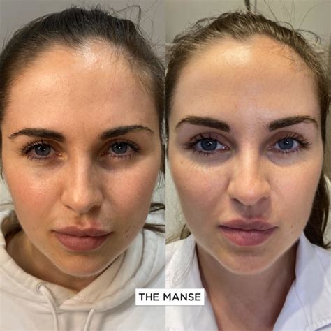 Eyebrow Lifting Best Cosmetic Clinic Sydney Advanced Practitioners