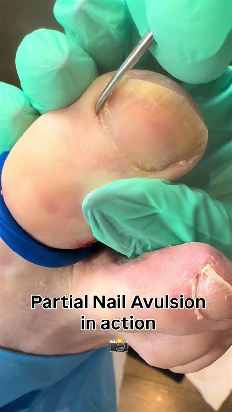 Partial Nail Avulsion Procedure For Ingrown Toenails Tiktok