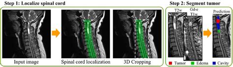 Fully Automatic Spinal Cord Tumor Segmentation Framework Step 1 The