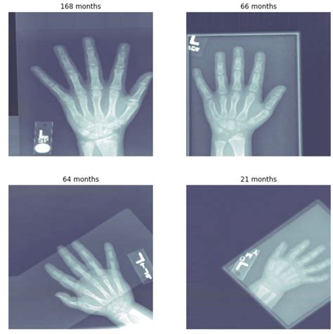 Extracting Clear Preprocessed Bone Image From The Hand X Ray Rmlquestions