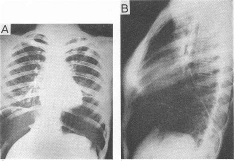 Figure I From Peri And Intra Hepatic Abscess Semantic Scholar