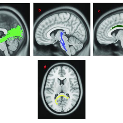 White Matter Pathways With Significantly Reduced Anisotropy In