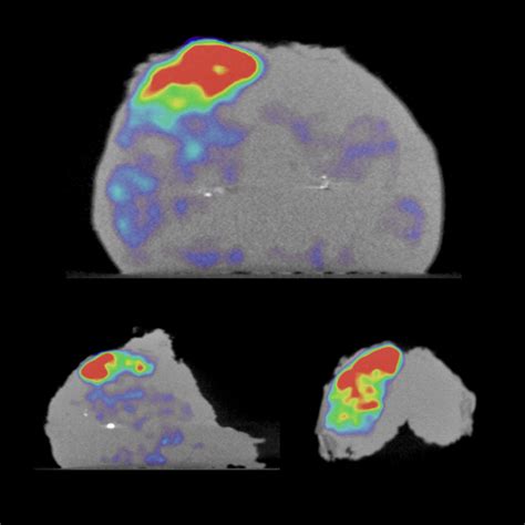 Imaging Case 10 Prostate Cancer Adenocarcinoma International English