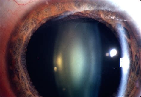 Moran Core Cataracts