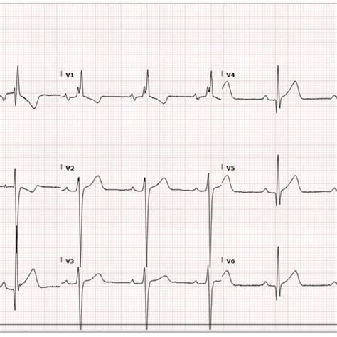 Cardiac Amyloidosis Ecg Showing Significant 1st Degree Av Block And