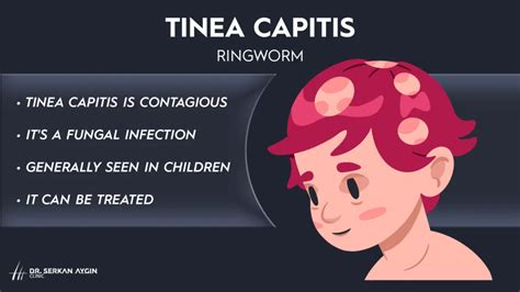 Tinea Capitis Symptoms And Treatment Dr Serkan Aygin