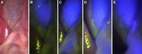 Feasibility Of Near Infrared Cholecysto Cholangiography And Evaluation Download Scientific Feasibility Of Near Infrared Cholecysto Cholangiography And Evaluation Download Scientific