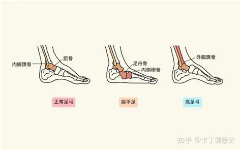 60 的儿童青少年存在足部健康问题！家长必须重视起来了！ 知乎