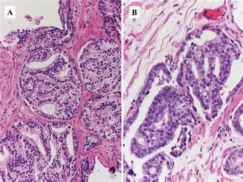 Prostate Cancer Pathology