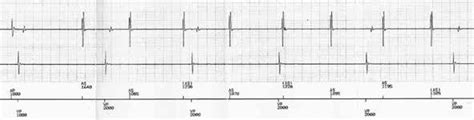 Temporary Programming Of The Pacemaker To The Stimulation Vvi Mode