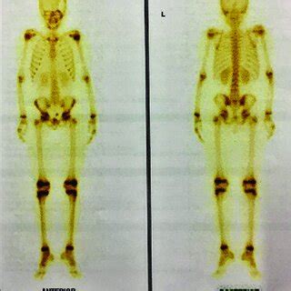 Technetium Bone Scan Showing No Abnormal Uptake Elsewhere In The Body Download Scientific