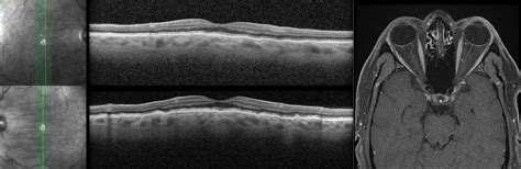 Lesson Choroidal Folds A New Wrinkle In Retinal Care