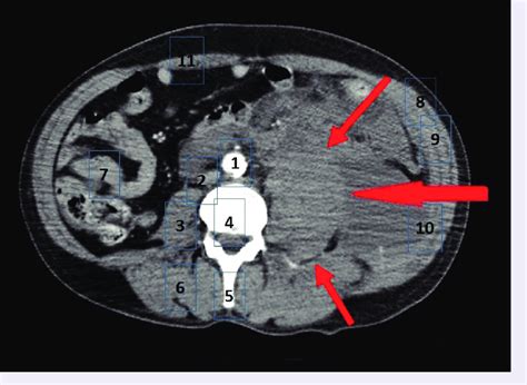 Psoas Hematoma
