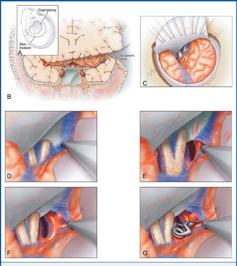 Cerebral Aneurysm Clip
