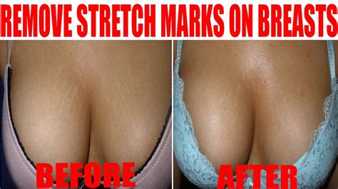 How To Remove Stretch Marks On Breasts Naturally Stretch Marks On