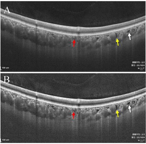 Ss Oct Showed Choroidal Vessels And Choroidal Caverns Without A And Download Scientific