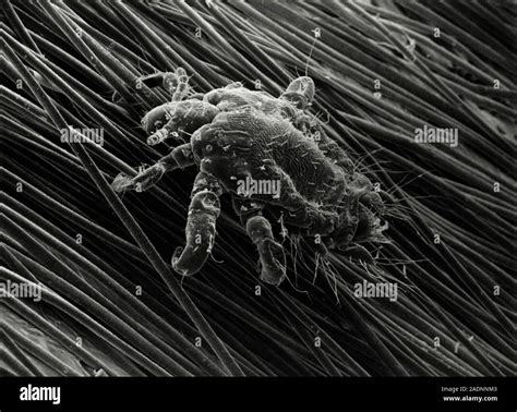 Scanning Electron Micrograph Sem Of The Pubic Louse Phthirus Pubis Also Known As The Crab