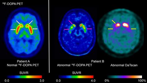 Evaluation Of Neurodegenerative Disorders With Amyloid β Tau And