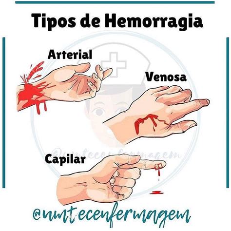 Dr Albertomeza — Tipos De Hemorragia