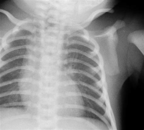 Rib Fracture For Diagnosis At George Ashcraft Blog