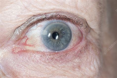 Bulging Eye In Hyperthyroidism Stock Image C011 1798 Science