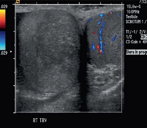 Testicular Torsion Radiology Key