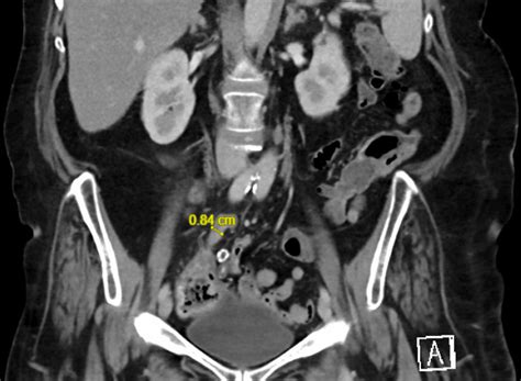 Xanthogranulomatous Appendicitis A Rare Pathological Finding