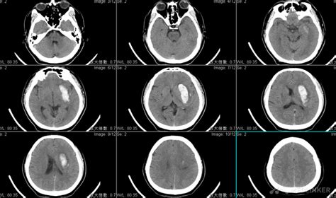 神经内镜辅助经左额脑出血清除术 医联