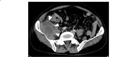 Ct Image Enhanced Computed Tomography Revealed A Heterogeneous Download Scientific Diagram