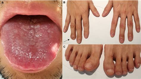 Figure 1 From Dyskeratosis Congenita With Heterozygous Rtel1 Mutations