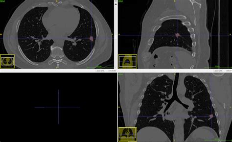 Lung Tumors And Nodules Segmentation With Deep Learning