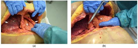 Clamshell Thoracotomy In A Cadaveric Model A Situs After Download Scientific Diagram