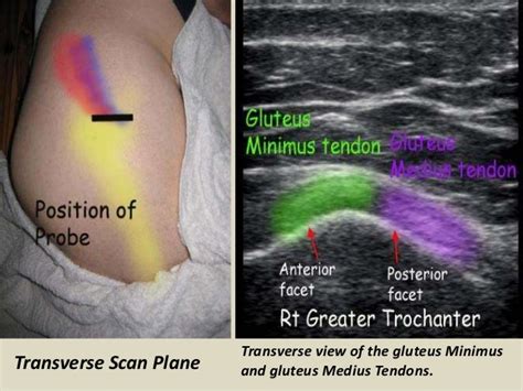 Presentation1pptx Ultrasound Examination Of The Hip Joint