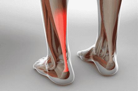 Achilles Tendon Lengthening Md West One Specialists