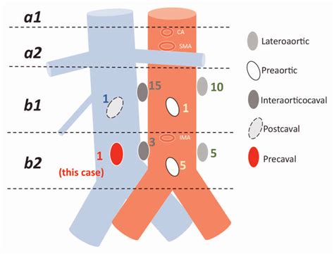 Anatomical Location Of Paraaortic Lymph Nodes With Metastasis Based On Download Scientific