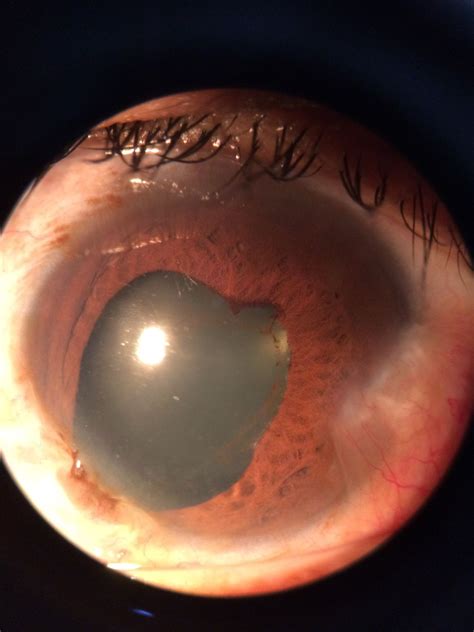 Dr Arturo Rodríguez On Linkedin Cataract Surgery And Iris Repair