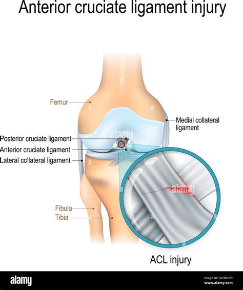 Anterior Cruciate Ligament Diagram Stock Vector Images Alamy