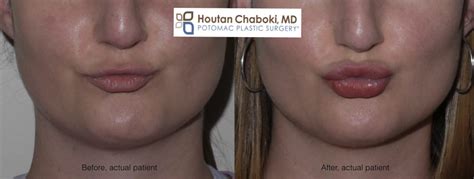 Lips Swollen After Filler