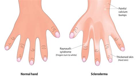 โรคหนังแข็ง สาเหตุ อาการ การรักษา วิธีป้องกัน
